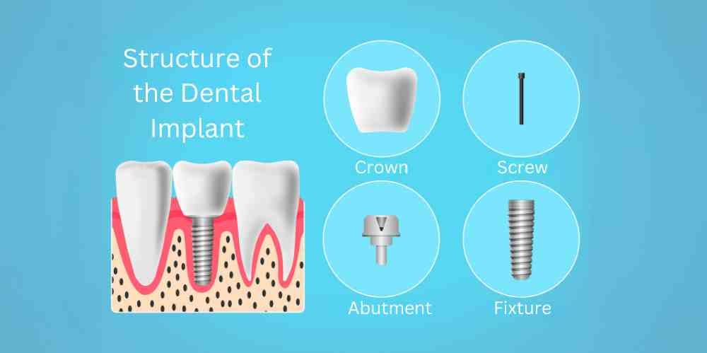 Understanding the Different Types of Dental Implants: Which Option Is ...